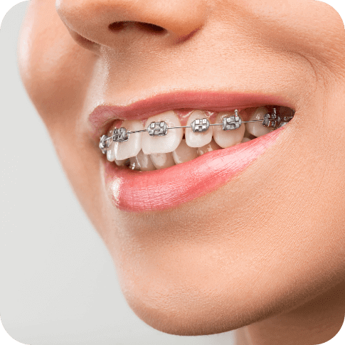 Rawatan Ortodontik & Pendakap Gigi Yang Berkesan | Lee Dental Kajang