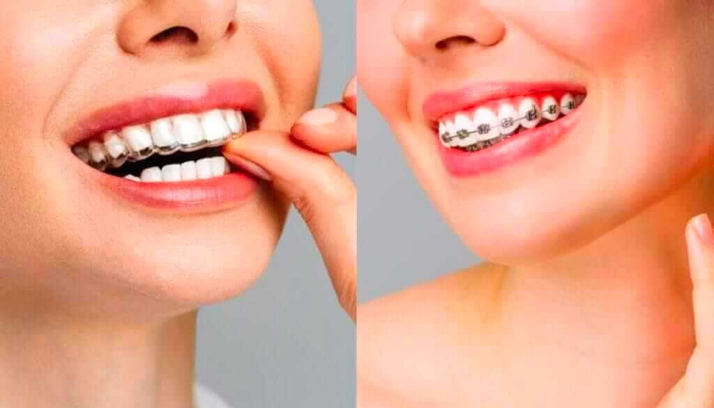 Angel Aligner vs. Traditional Braces - Which is Better?